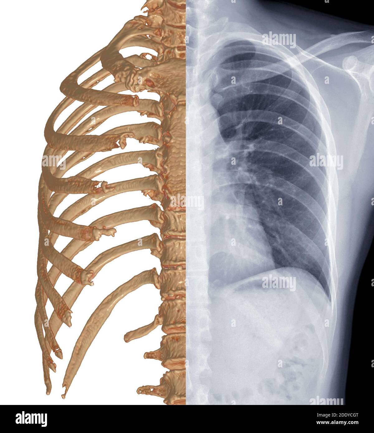 Brustkorb Anatomie Stockfotos und -bilder Kaufen - Alamy