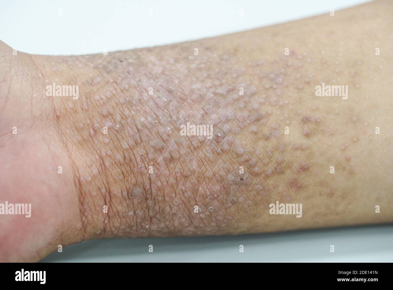 Dermatologie detail -Fotos und -Bildmaterial in hoher Auflösung – Alamy