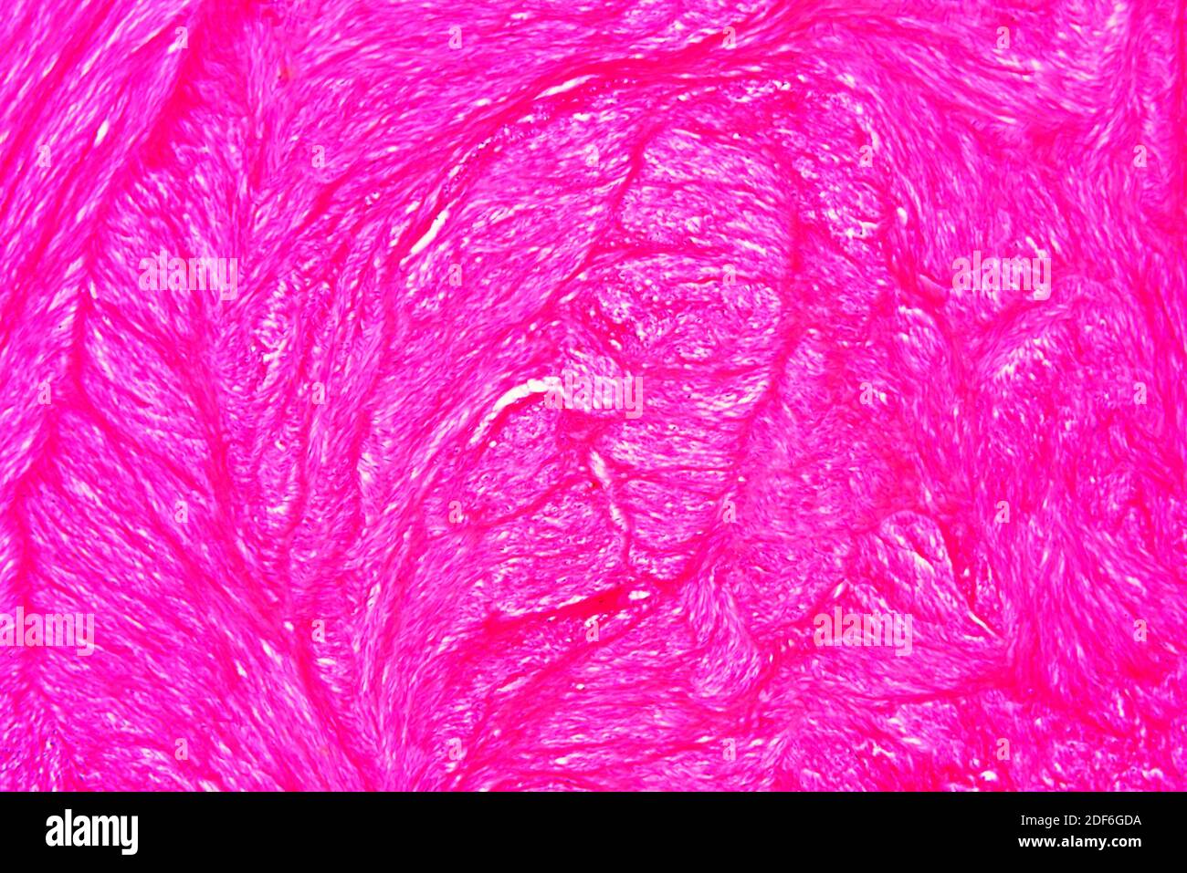 Myom tumor -Fotos und -Bildmaterial in hoher Auflösung – Alamy