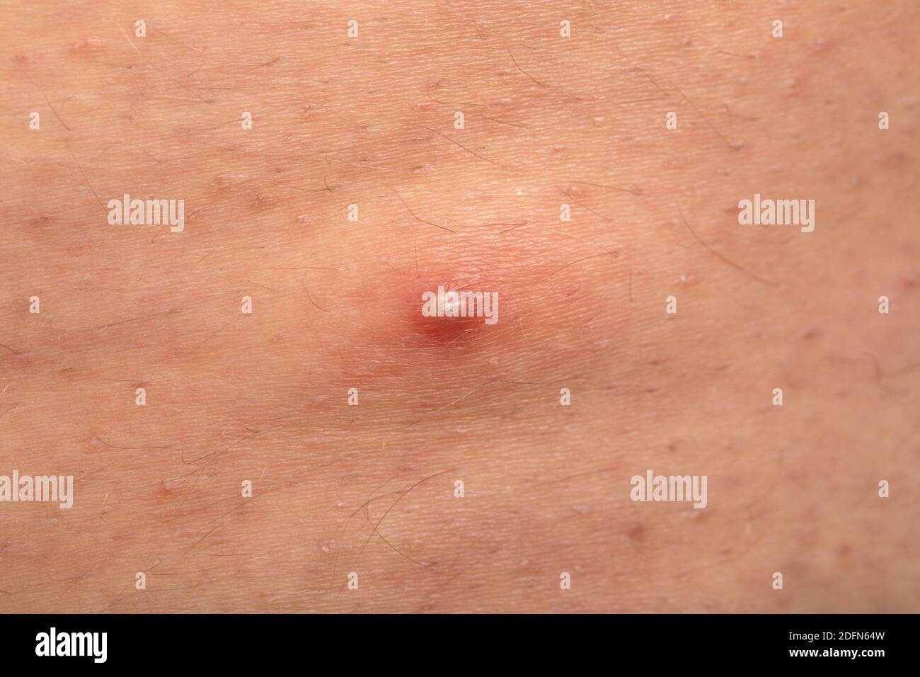 Hormonstörung -Fotos und -Bildmaterial in hoher Auflösung – Alamy