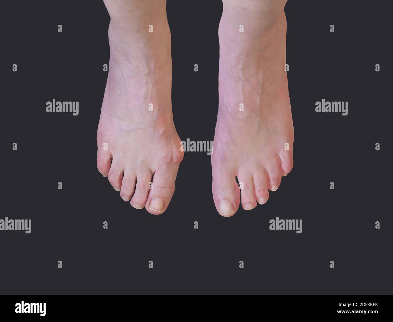 Hallux valgus -Fotos und -Bildmaterial in hoher Auflösung – Alamy