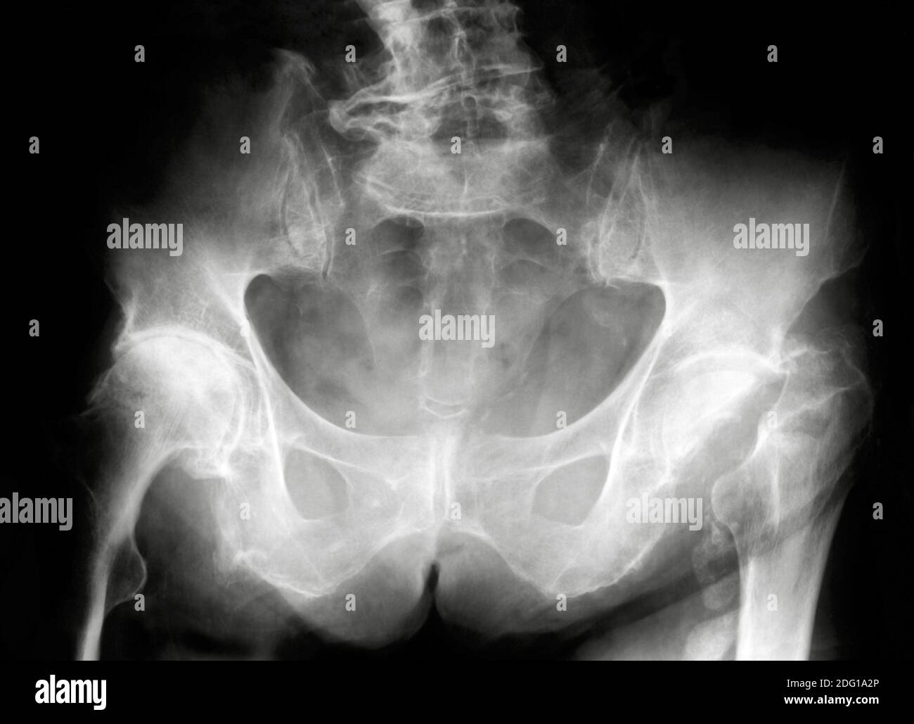 Pelvis and bones -Fotos und -Bildmaterial in hoher Auflösung – Alamy
