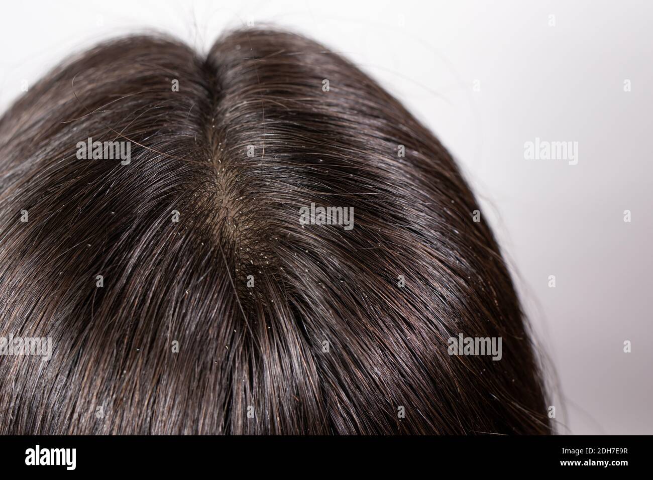 Psoriasis problem -Fotos und -Bildmaterial in hoher Auflösung – Alamy