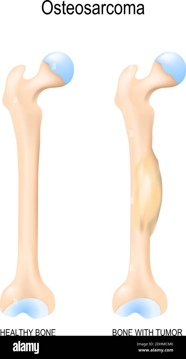 Osteosarkom. Das osteogene Sarkom ist ein krebsartiger Tumor im Knochen ...