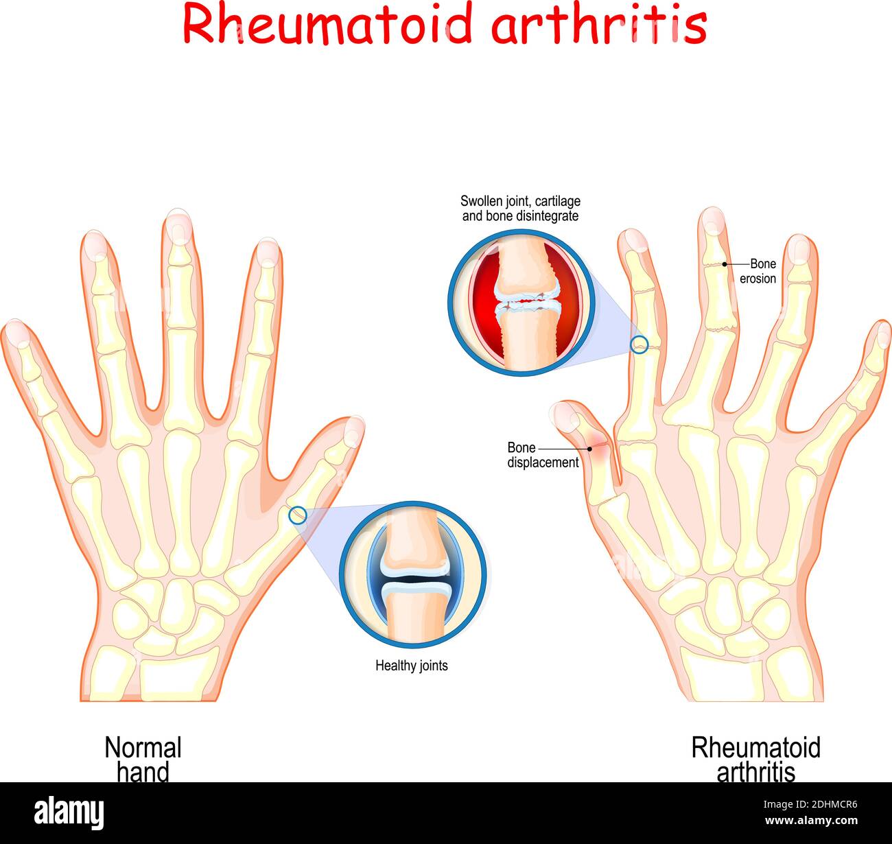 Rheuma finger illustration Stock-Vektorgrafiken kaufen - Alamy