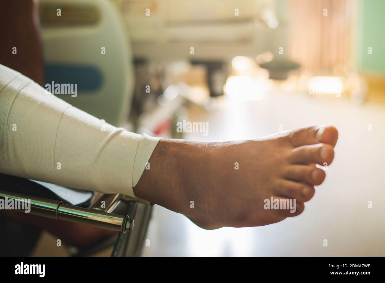Bein Gebrochen Mann Mit Gipsfuss Stockfotos und -bilder Kaufen - Alamy