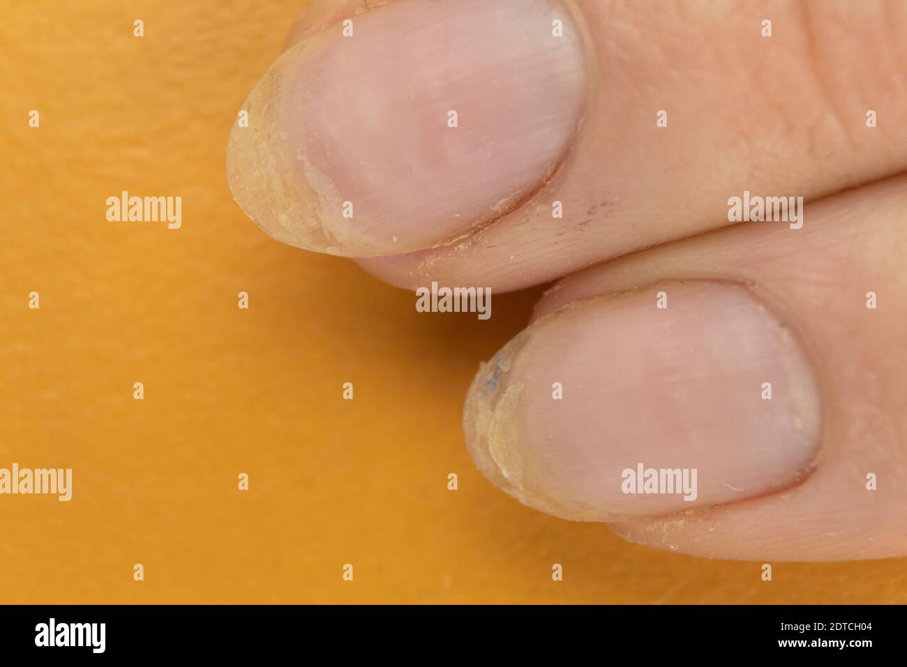 Nagelpilz finger -Fotos und -Bildmaterial in hoher Auflösung – Alamy