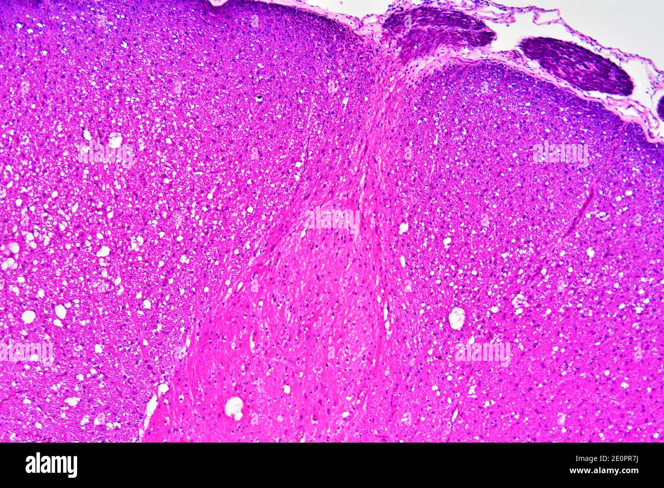 Spinal meninges -Fotos und -Bildmaterial in hoher Auflösung – Alamy