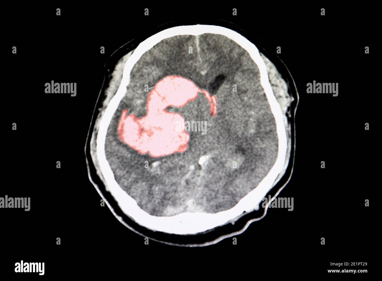 Ein CT-Scan eines Schlaganfallpatienten, der intrazerebrale Blutungen ...