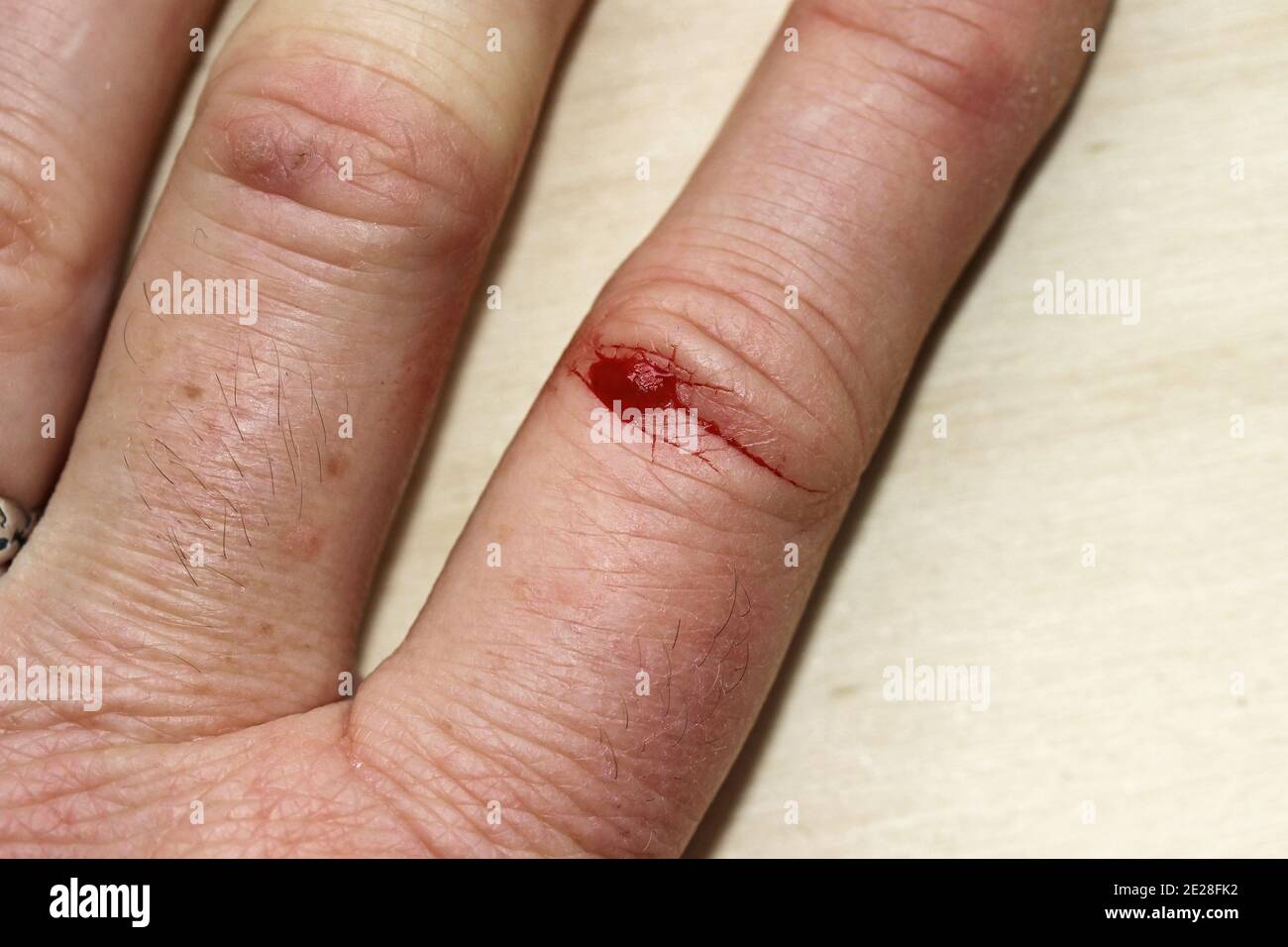 Eine blutende Verletzung am Finger einer Frau. Eine blutende Wunde an ...