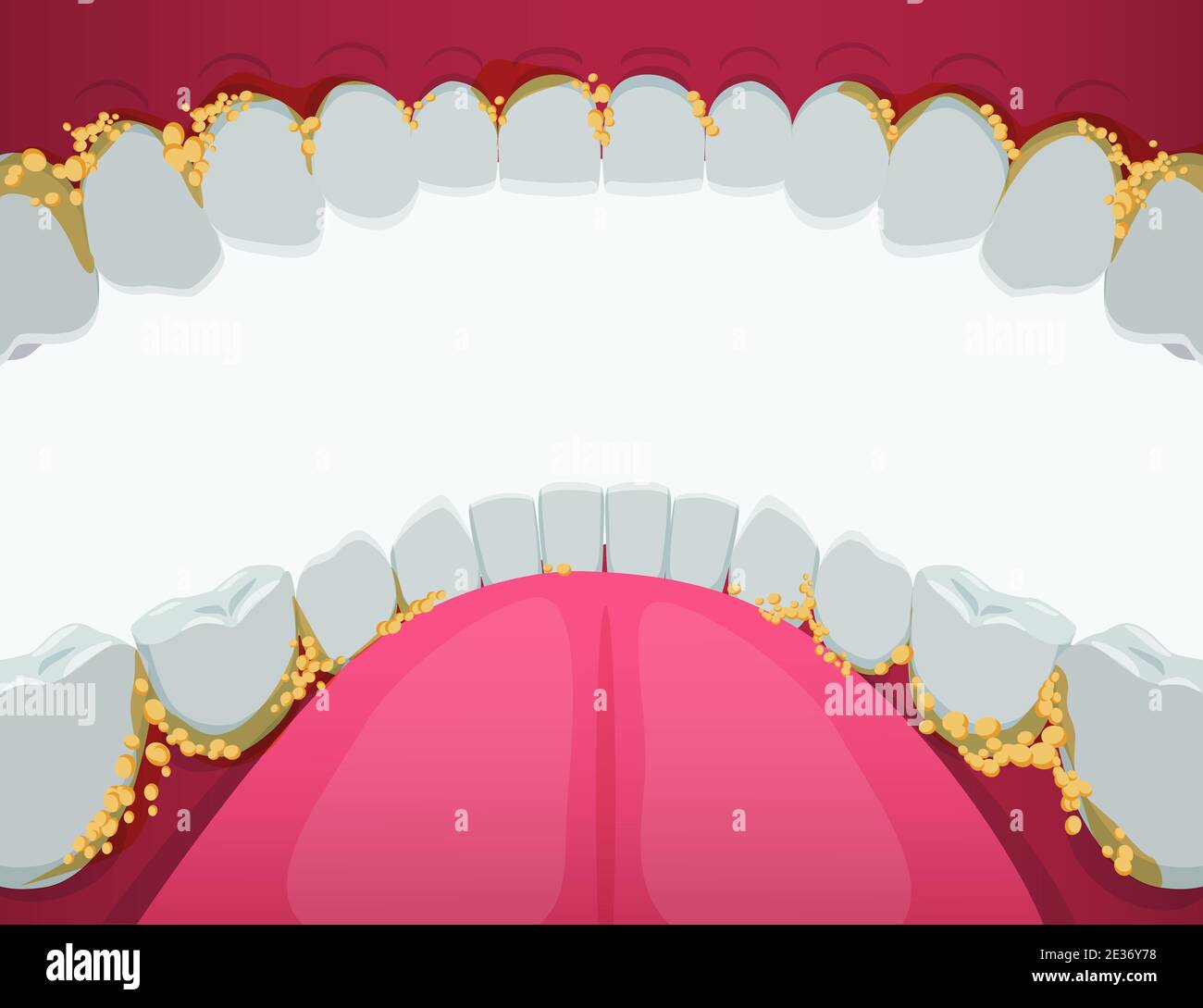 Mundhöhle mit Zahnstein Cliparts. Gelbe problematische Plaque und ...