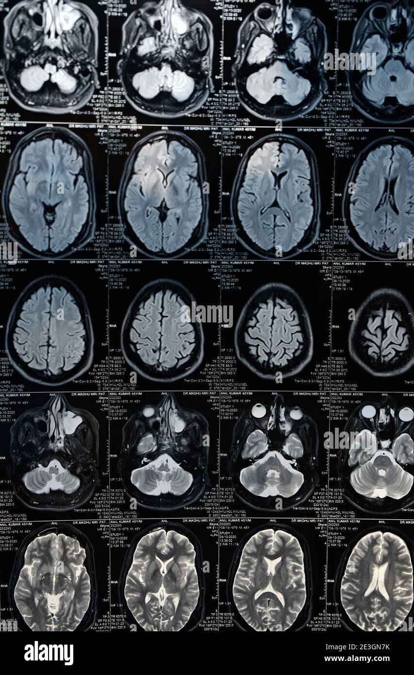 Mri scan brain -Fotos und -Bildmaterial in hoher Auflösung - Seite 2 ...