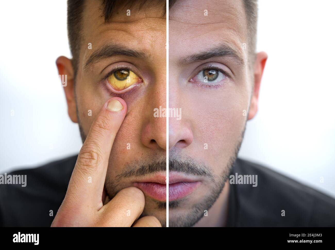 Gelbe gelbsucht -Fotos und -Bildmaterial in hoher Auflösung – Alamy