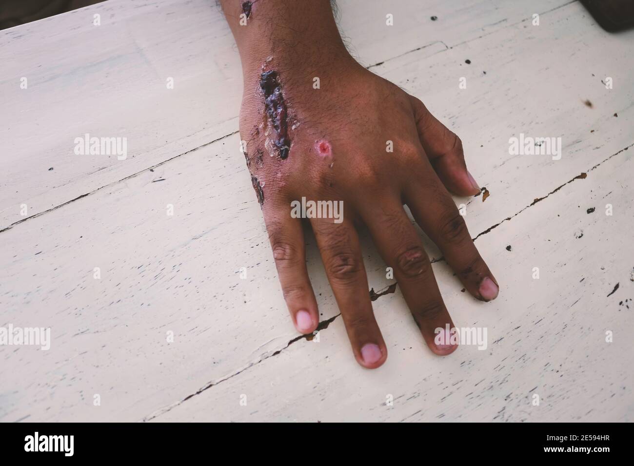 Verwundeter patient -Fotos und -Bildmaterial in hoher Auflösung – Alamy