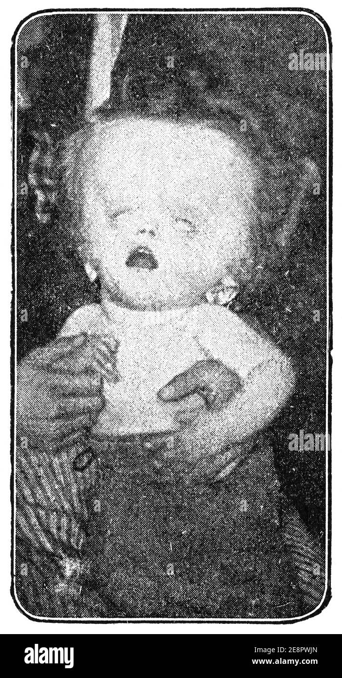 Ein Kind, das an Rachitis leidet. Illustration des 19. Jahrhunderts ...