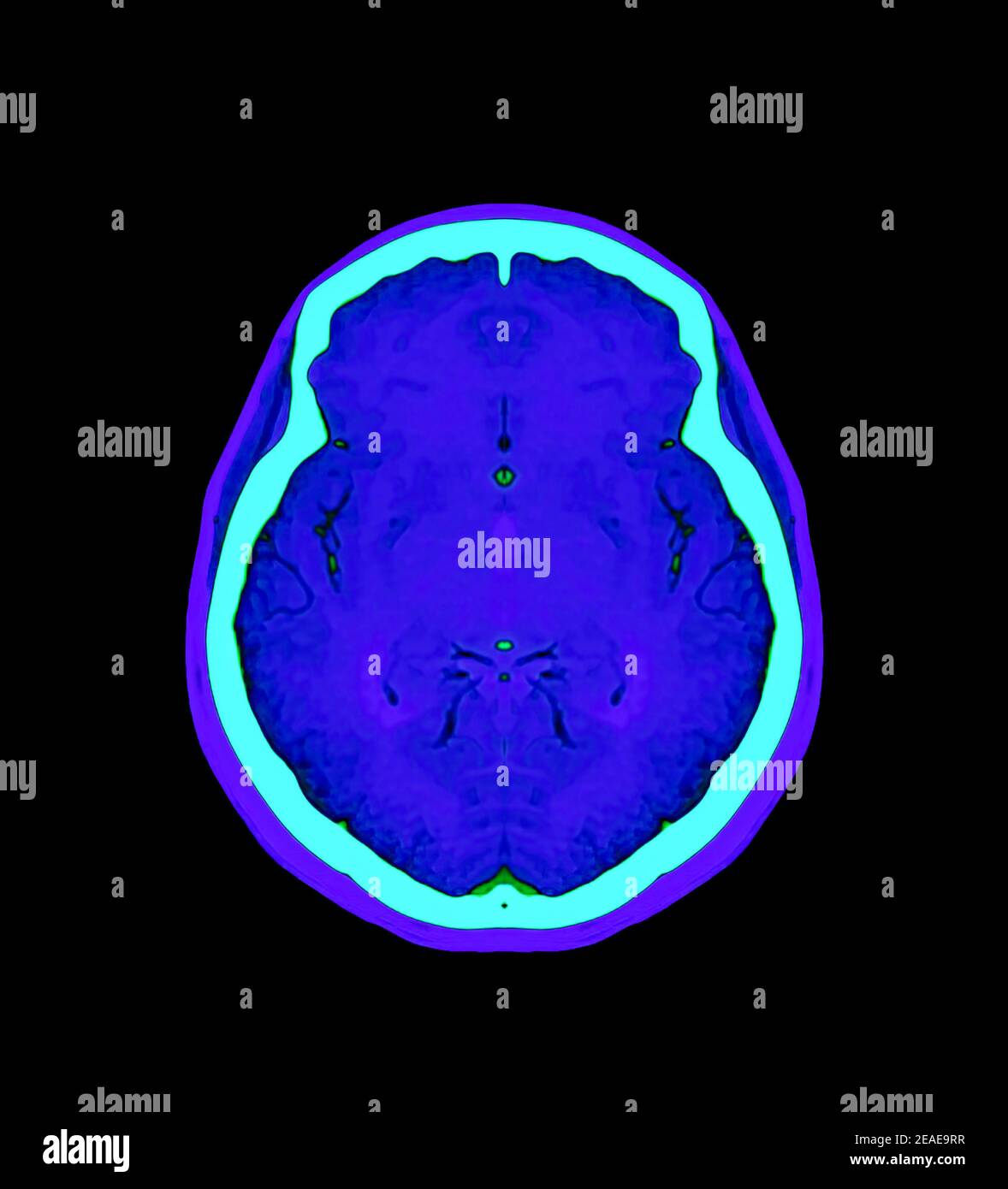 Bunte CT-Angiographie des Gehirns oder CTA Gehirn Axial , Koronal und ...