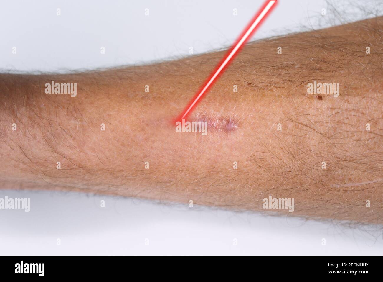 Scar surgery -Fotos und -Bildmaterial in hoher Auflösung – Alamy