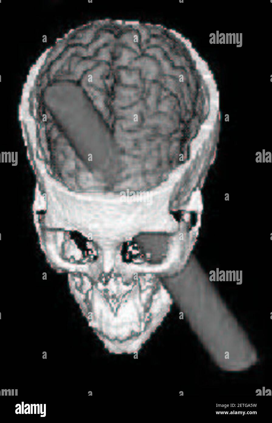 Phineas gage -Fotos und -Bildmaterial in hoher Auflösung – Alamy