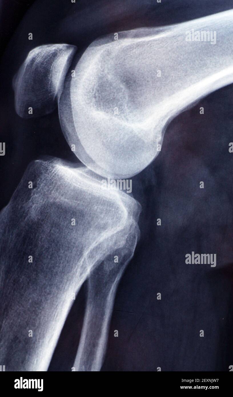 Femur bone xray -Fotos und -Bildmaterial in hoher Auflösung – Alamy