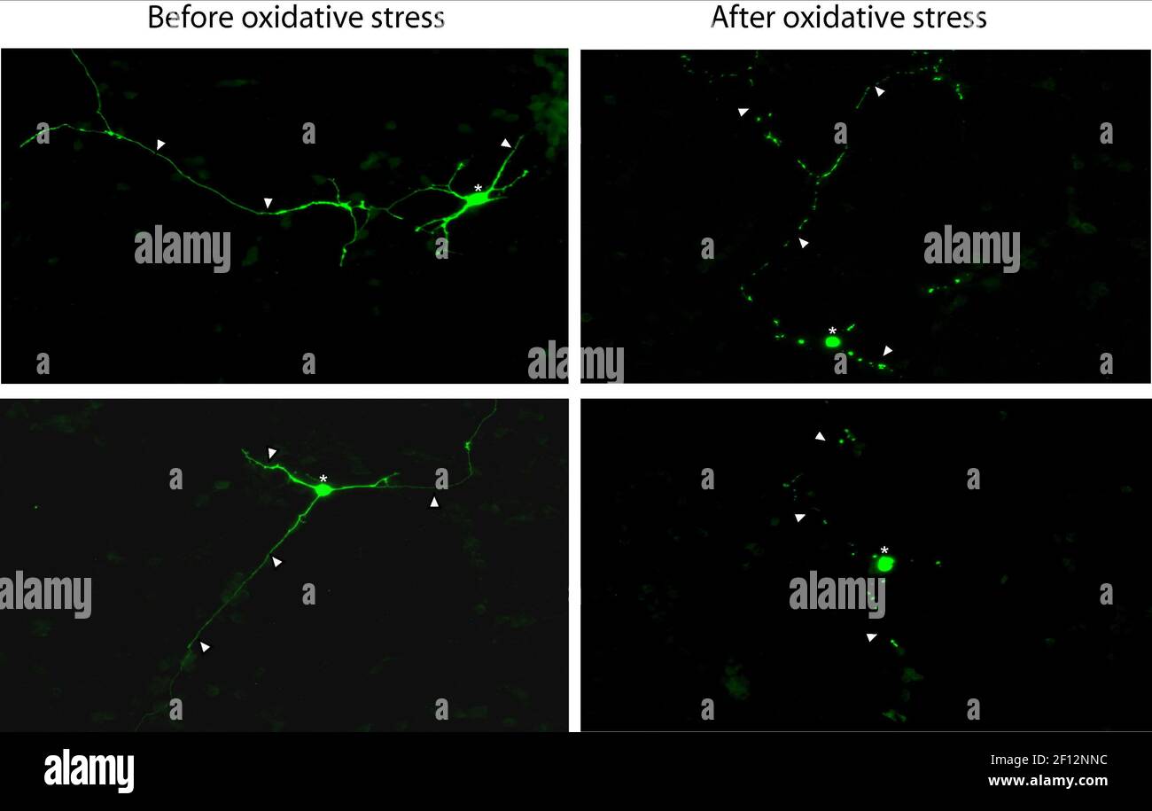 Diese vorher-Nachher-Fotos zeigen, wie oxidativer Stress, der durch den ...