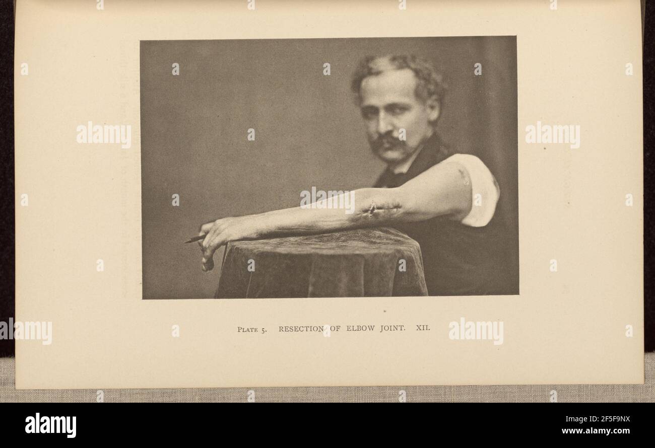 Resektion ellenbogen -Fotos und -Bildmaterial in hoher Auflösung – Alamy