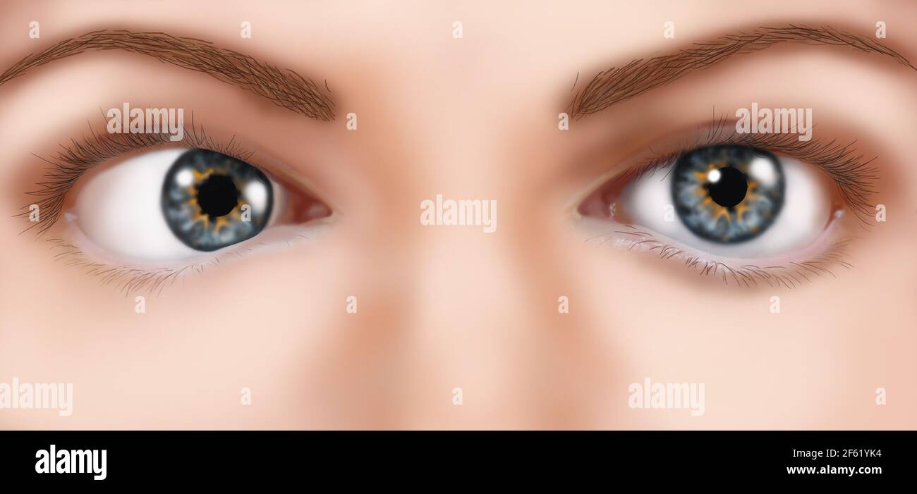 Strabismus esotropie -Fotos und -Bildmaterial in hoher Auflösung – Alamy