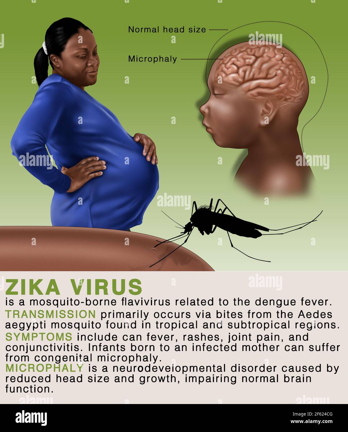 Mikrozephalie krankheit -Fotos und -Bildmaterial in hoher Auflösung – Alamy