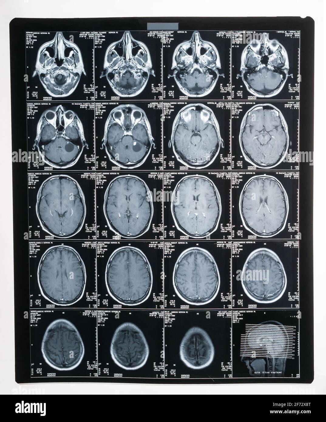 Seitliche mri -Fotos und -Bildmaterial in hoher Auflösung – Alamy