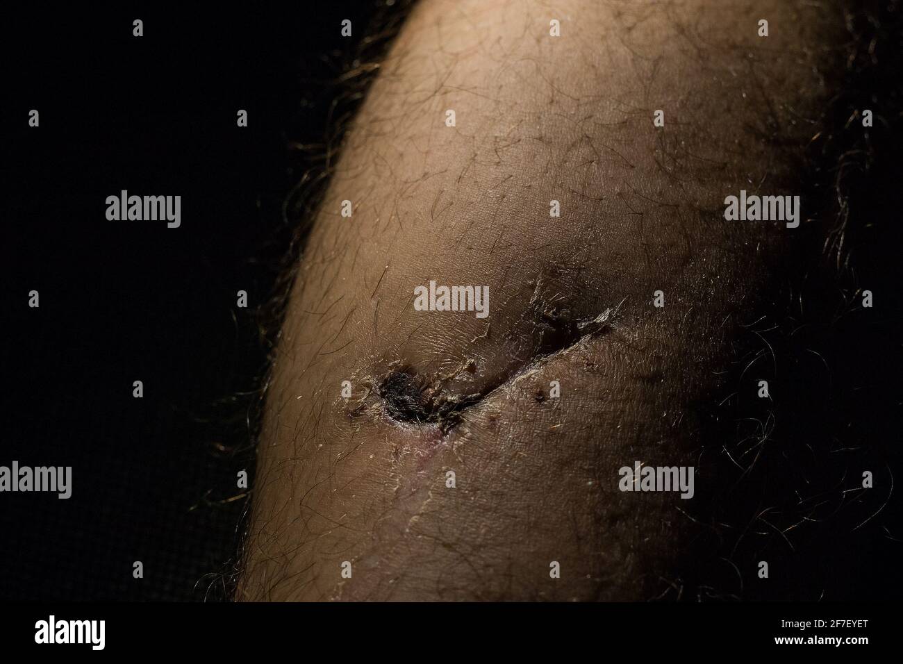 Offene wunde am bein -Fotos und -Bildmaterial in hoher Auflösung – Alamy
