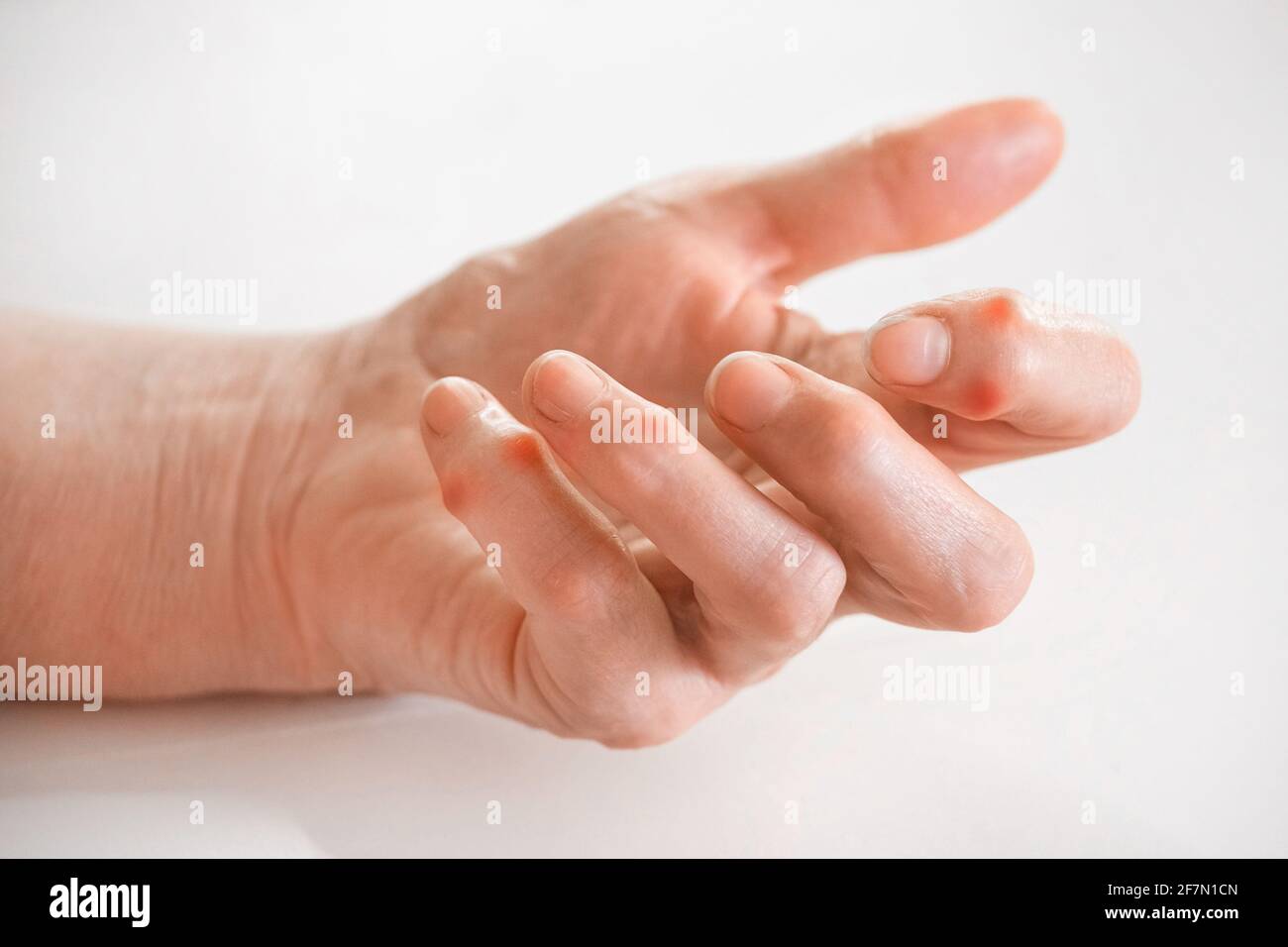 Arthrose finger -Fotos und -Bildmaterial in hoher Auflösung – Alamy