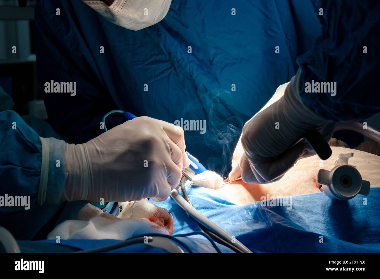 Blutbefleckte handschuhe des krankenhauschirurgen -Fotos und ...