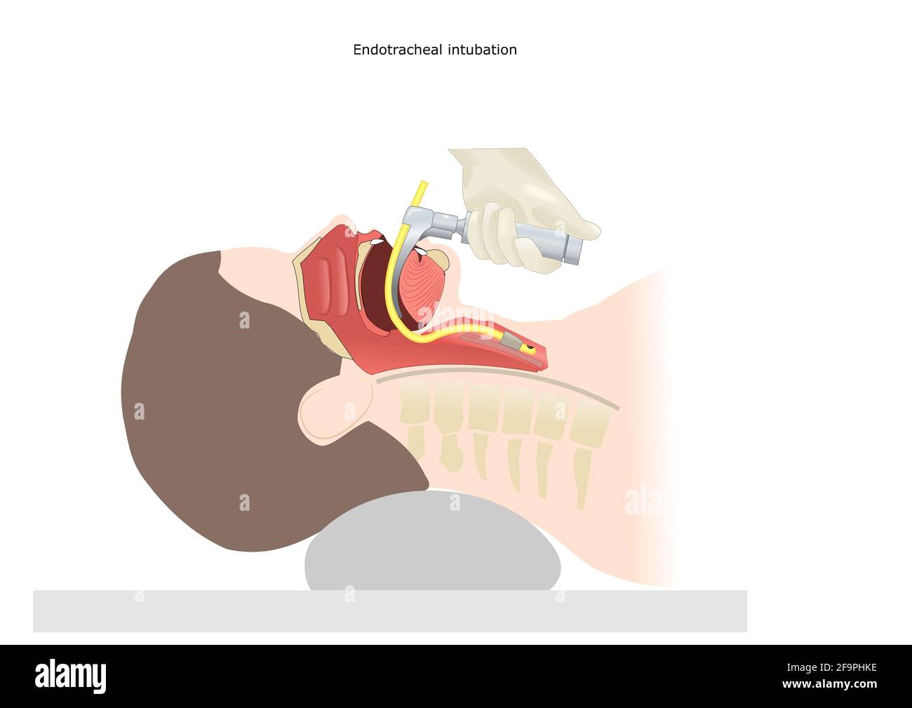Endotracheal intubation Ausgeschnittene Stockfotos und -bilder - Alamy