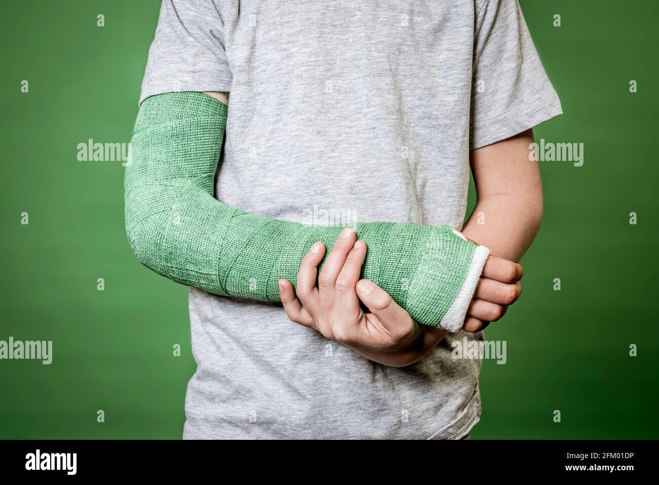 Plaster Cast Arm Stockfotos und -bilder Kaufen - Alamy