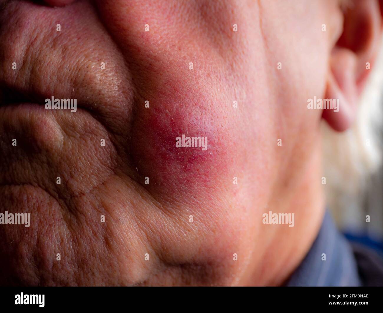 Pus abscess -Fotos und -Bildmaterial in hoher Auflösung – Alamy