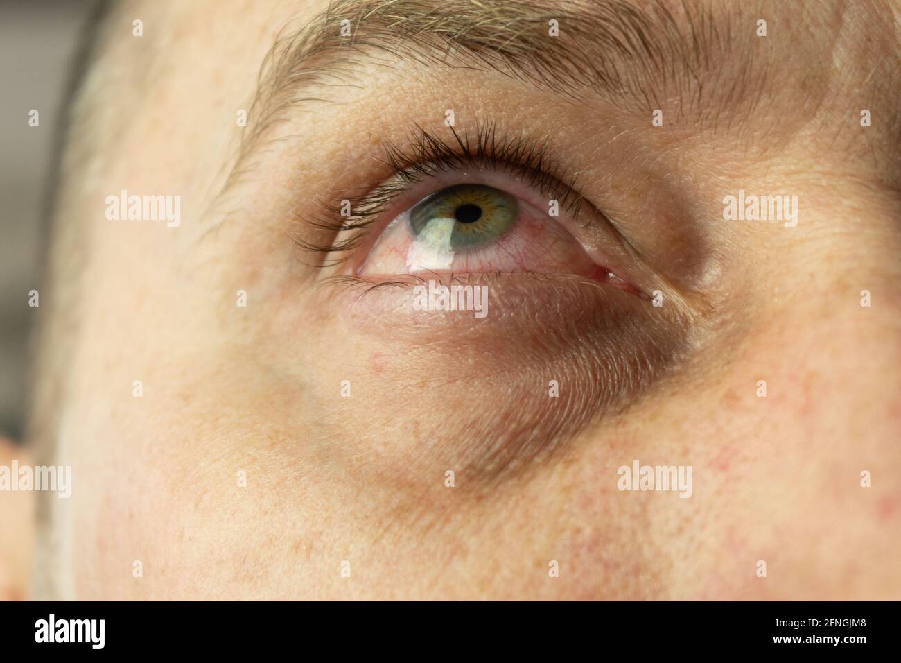 Rote und entzündete Augen aus der Nähe. Rote Augen des Patienten ...