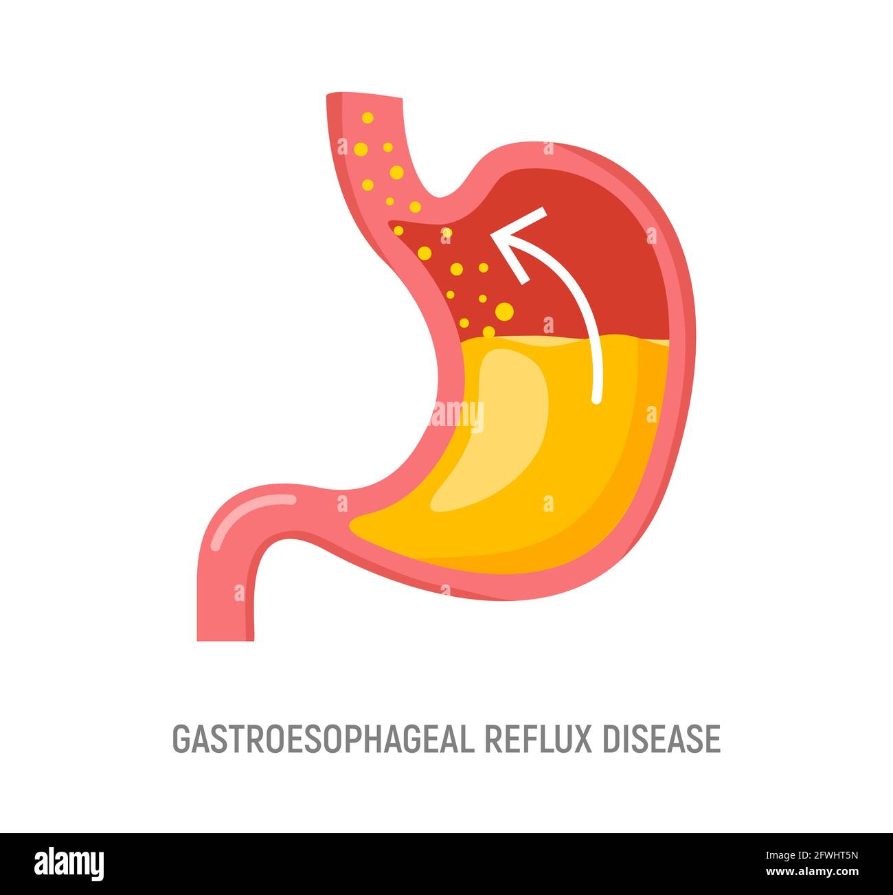 Gastroösophageale Refluxkrankheit. Magen GERD Sodbrennen Speiseröhre ...