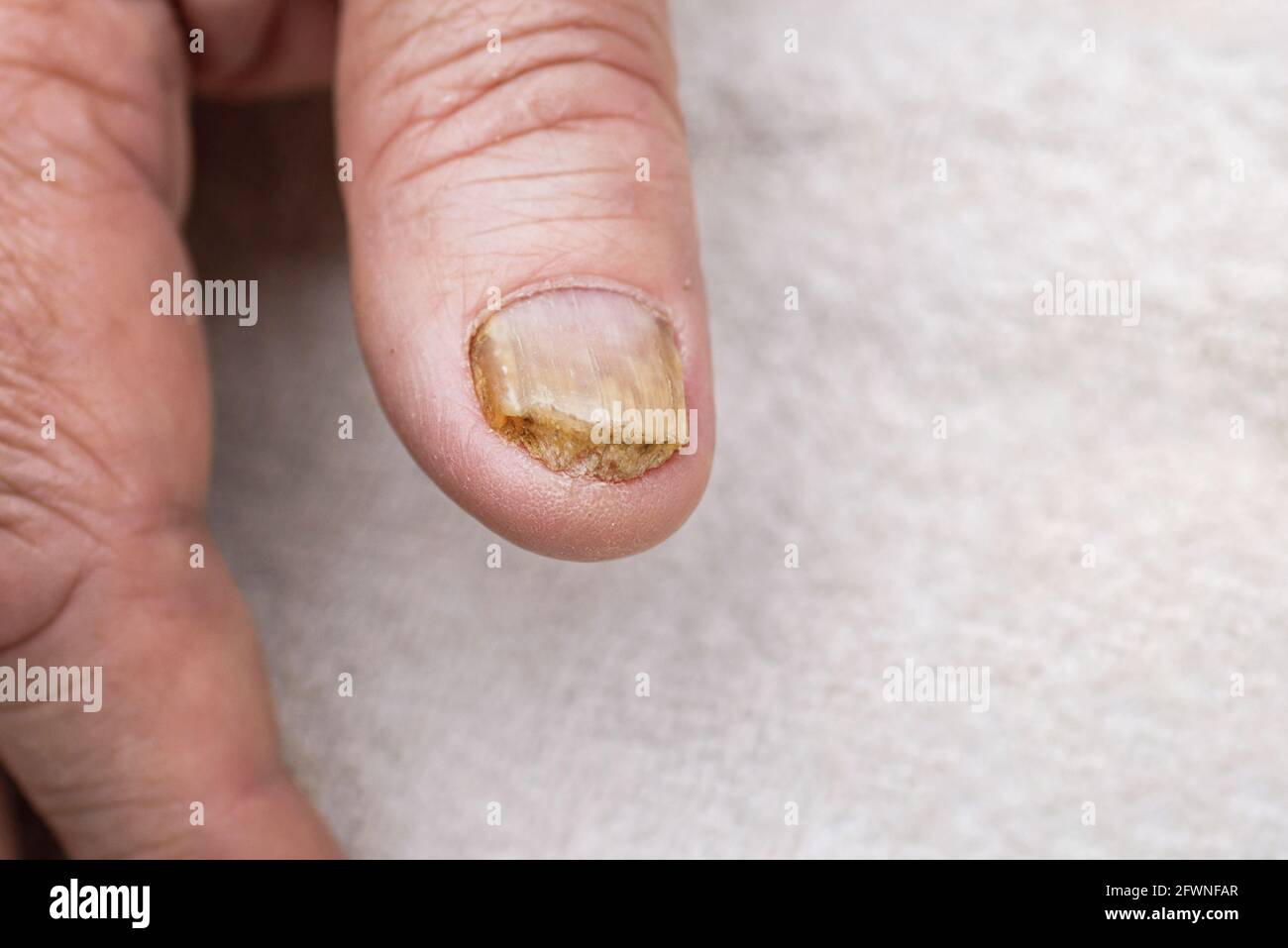 Nail fungus finger Fotos und Bildmaterial in hoher Auflosung Alamy