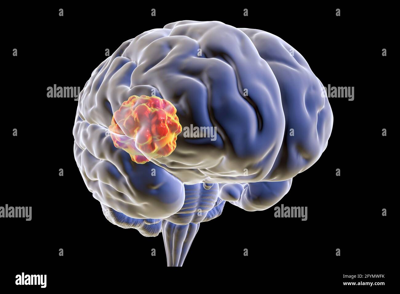Nashorn orbital hirn mukormykose -Fotos und -Bildmaterial in hoher ...