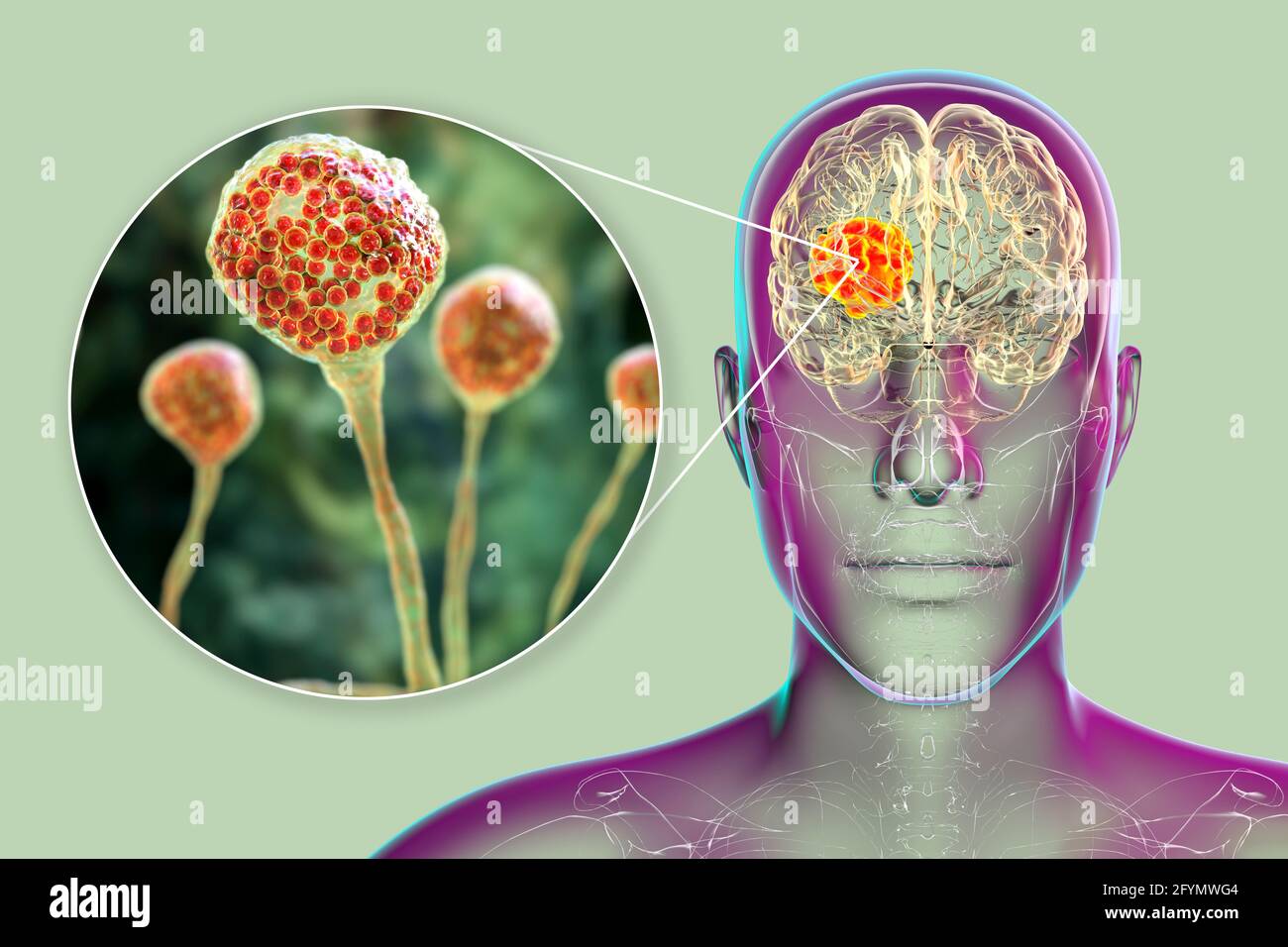 Nashorn orbital hirn mukormykose -Fotos und -Bildmaterial in hoher ...