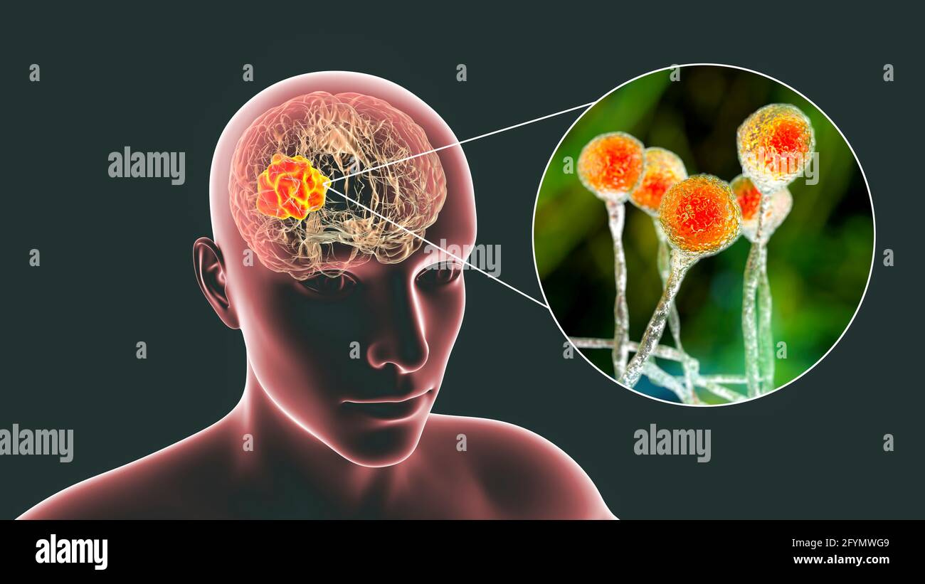 Nashorn orbital hirn mukormykose -Fotos und -Bildmaterial in hoher ...