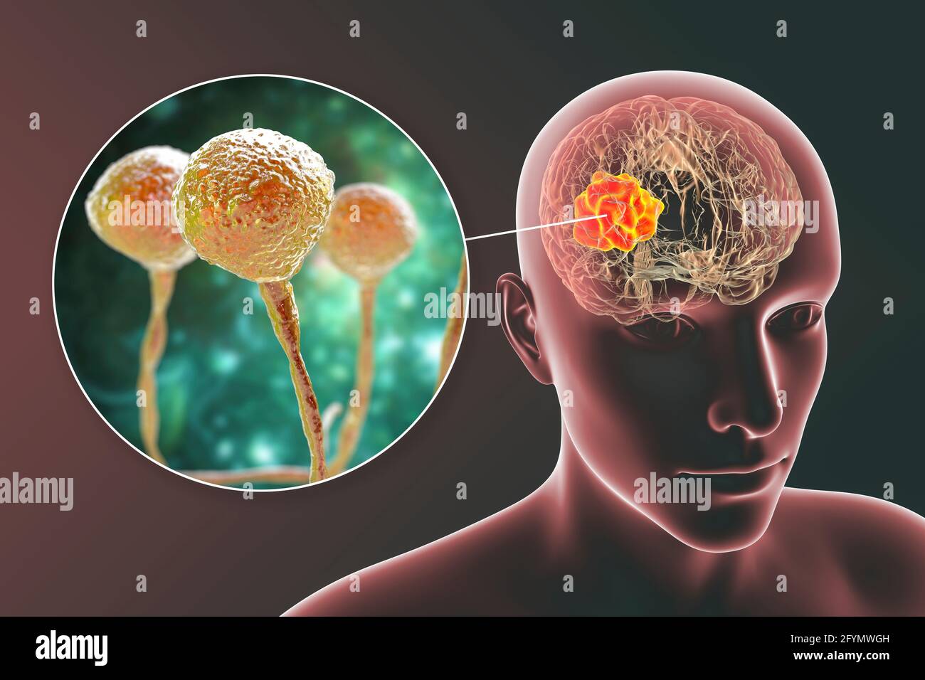 Nashorn orbital hirn mukormykose -Fotos und -Bildmaterial in hoher ...