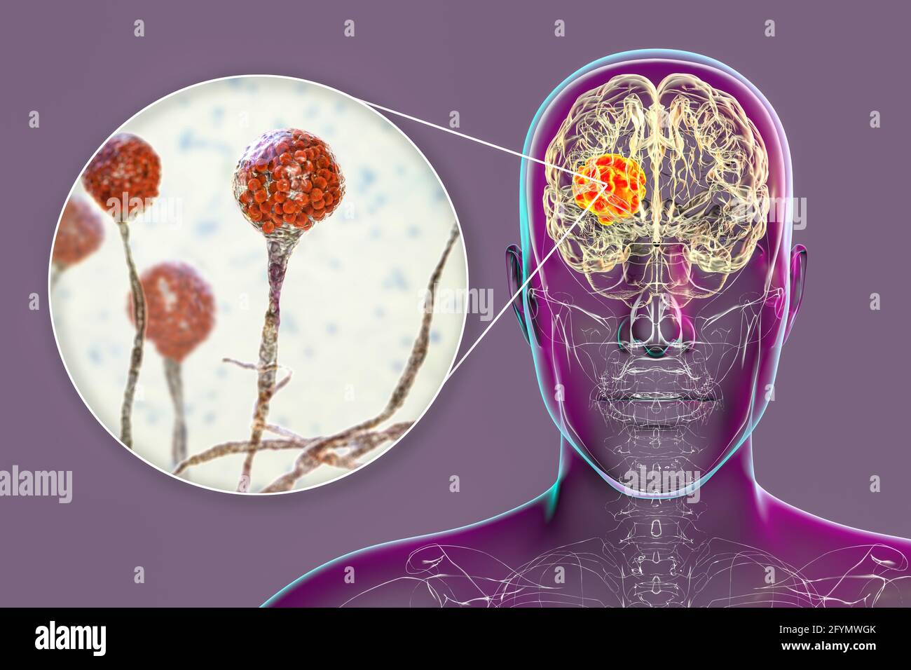 Nashorn orbital hirn mukormykose -Fotos und -Bildmaterial in hoher ...