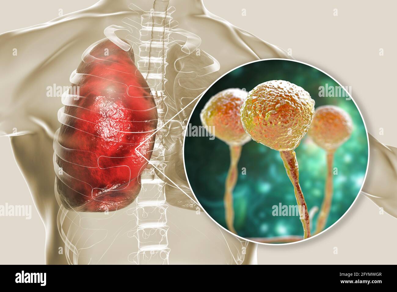 Pulmonale mukormykose -Fotos und -Bildmaterial in hoher Auflösung – Alamy