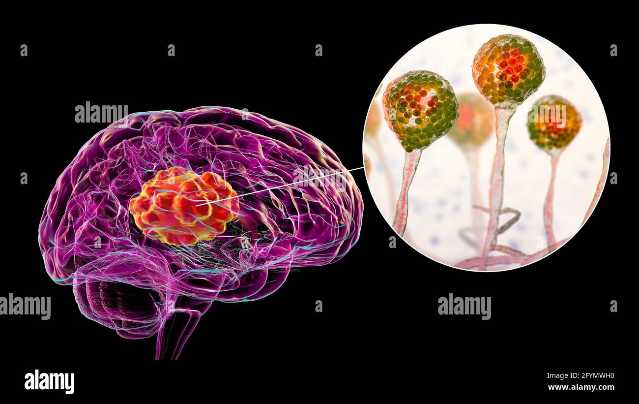 Nashorn orbital hirn mukormykose -Fotos und -Bildmaterial in hoher ...