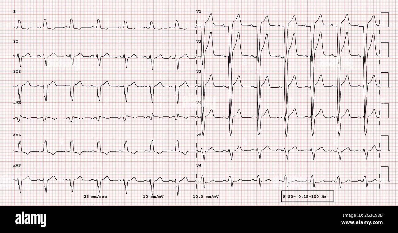 EKG-Beispiel für 12-Kanal-Rhythmus, Linksschenkelblock, reale ...