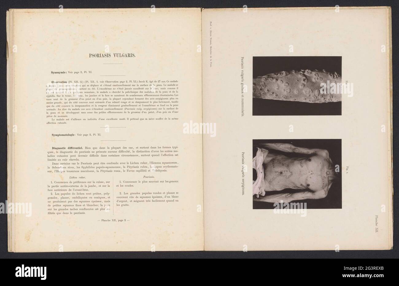 Patienten mit der Hauterkrankung „Psoriasis vulgaris guttata et ...