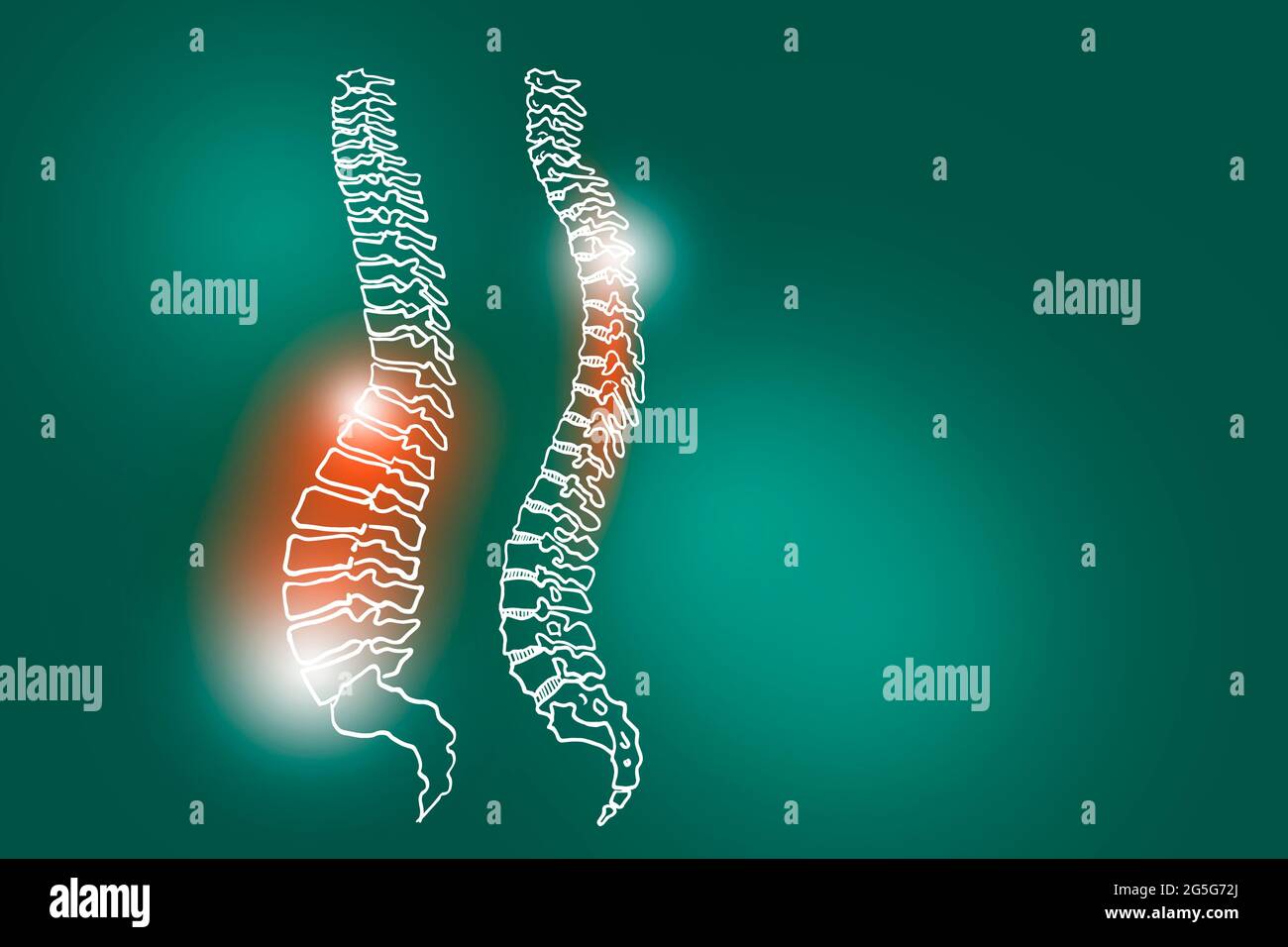 Lumbale radikulopathie -Fotos und -Bildmaterial in hoher Auflösung – Alamy