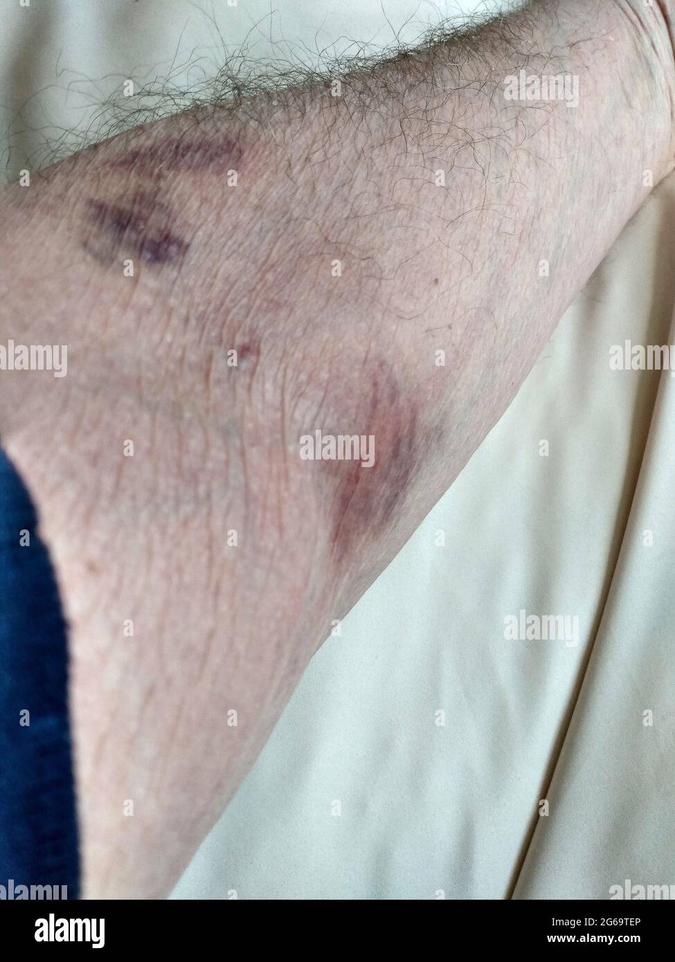 Blaue flecken und narben -Fotos und -Bildmaterial in hoher Auflösung ...