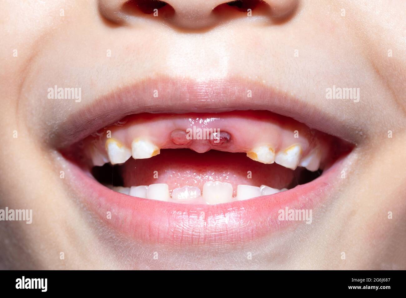 Schneidezahn kind -Fotos und -Bildmaterial in hoher Auflösung – Alamy