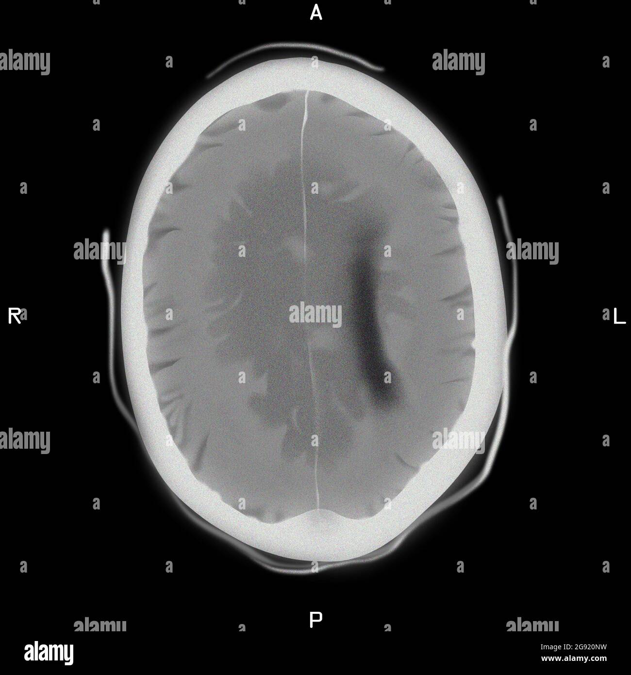 Hämatom hämatom -Fotos und -Bildmaterial in hoher Auflösung – Alamy